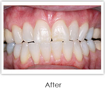 Teeth Whitening Wilbraham MA | Cosmetic Dentist Springfield, Hampden ...