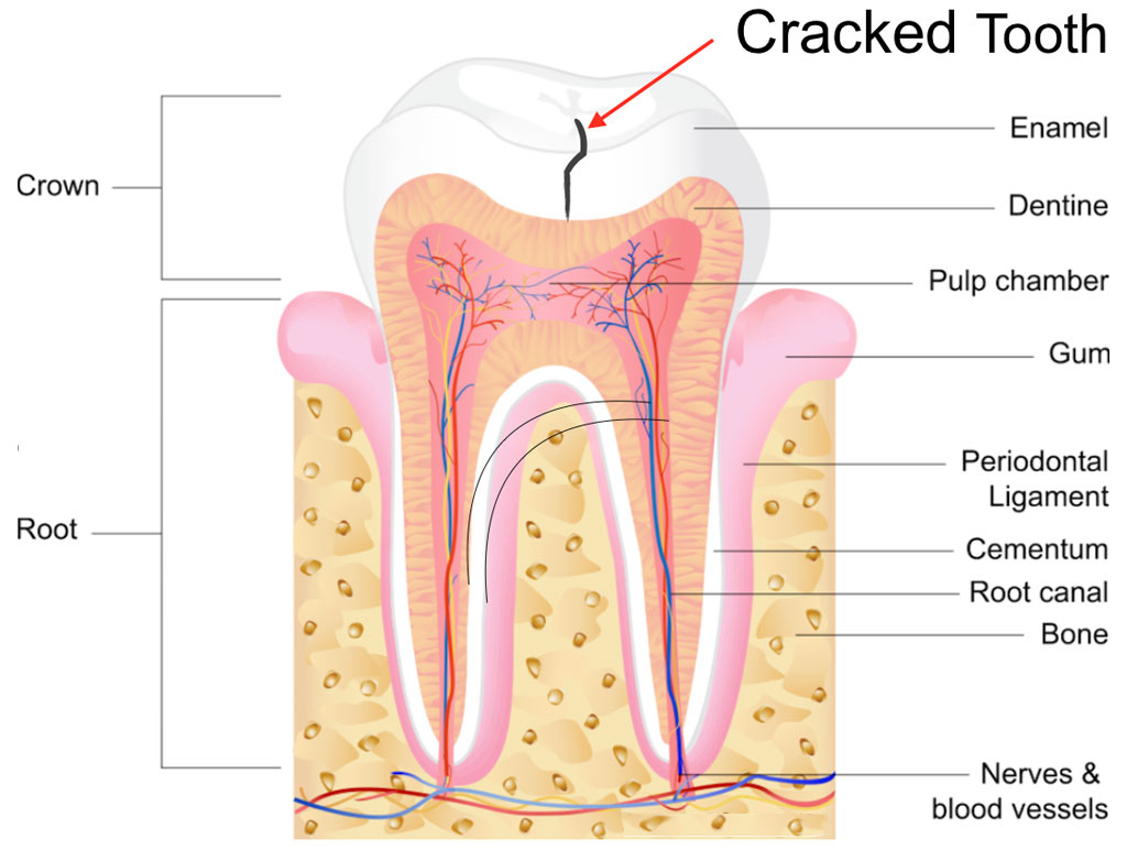 Root Canal Springfield MA | Crowns, Endodontics, Pulpotomy Wilbraham ...