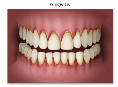 Periodontics Springfield MA | Hygienist, Dental Implants, Scaling and ...